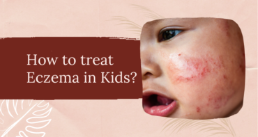 What is Atopic Dermatitis Treatment, Symptoms and Causes?