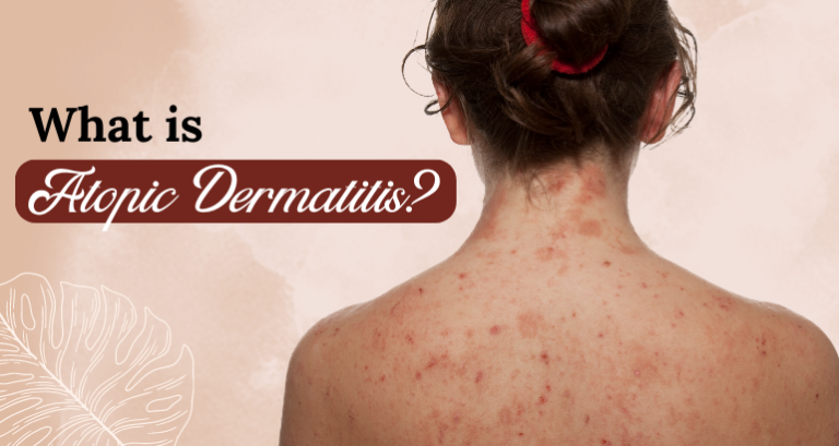 What Is Atopic Dermatitis Treatment Symptoms And Causes