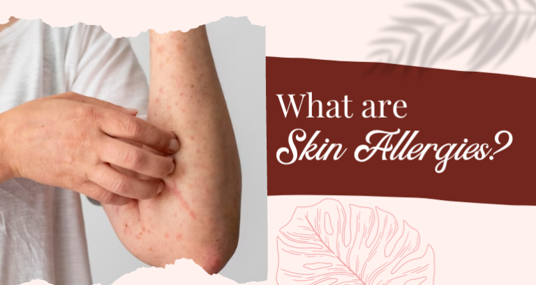 Skin Allergies Cause, Symptoms and Treatment | Dr. Pallavi